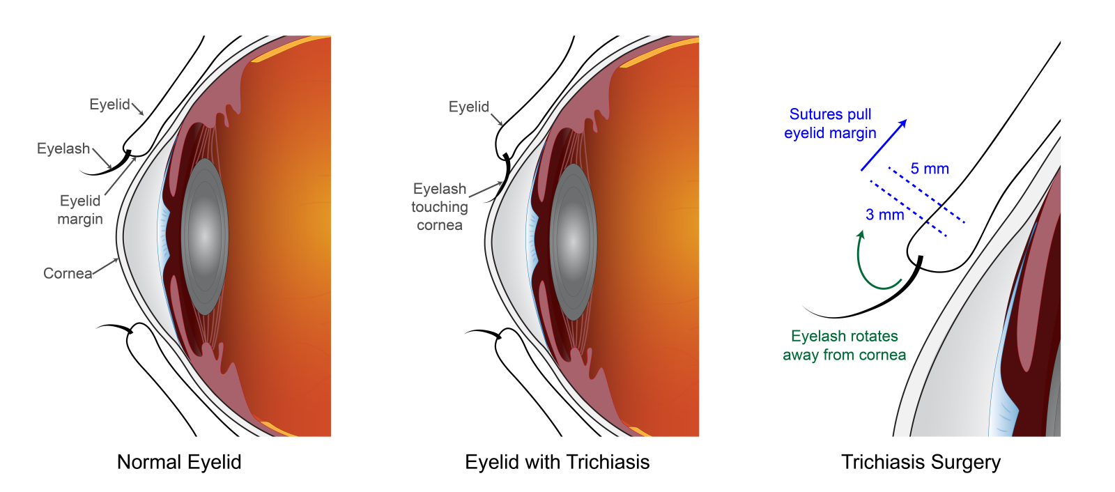 Two Common Surgeries Equally Effective For Treating Blinding Condition two-common-surgeries-equally-effective-for-treating-blinding-condition